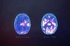 Transcranial Magnetic Stimulation | TMS Therapy Near Chicago